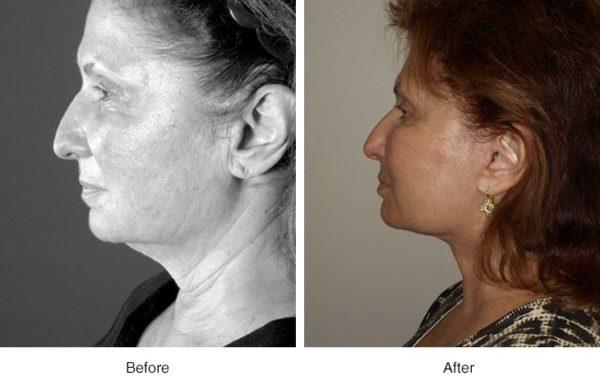 Manhattan Neck Lift by Dr Robert Freund, Top NY Plastic Surgeon