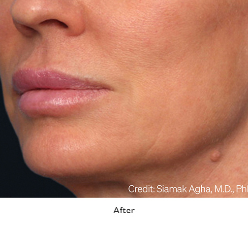 Ellacor Micro-Coring Dr. Rober Freund, Top NYC Plastic Surgeon