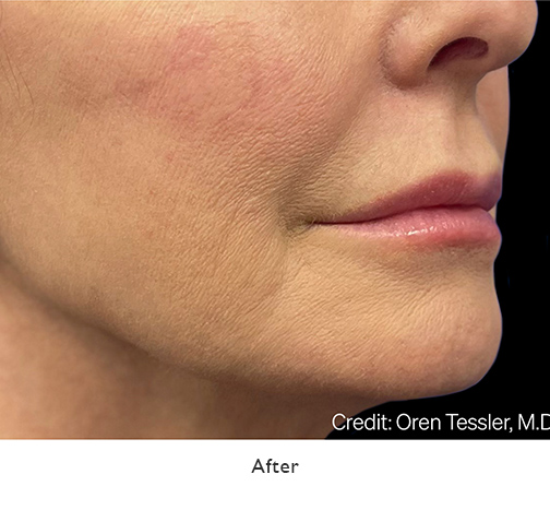 Ellacor Micro-Coring Dr. Rober Freund, Top NYC Plastic Surgeon