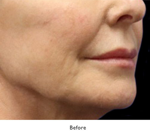 Ellacor Micro-Coring Dr. Rober Freund, Top NYC Plastic Surgeon